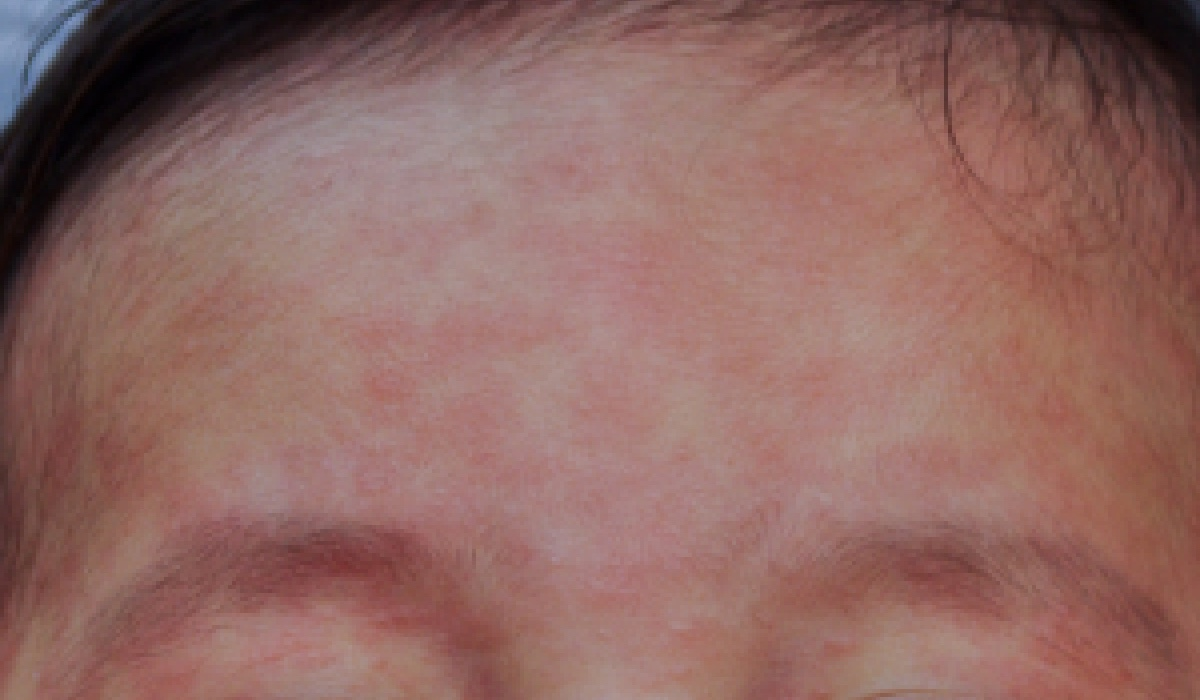 Measles | Recent Illness or Concern | Healthier Together