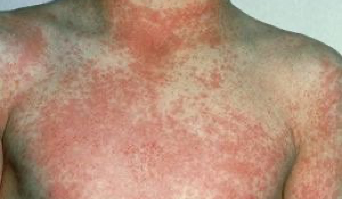 Scarlet Fever | Recent Illness or Concern | Healthier Together