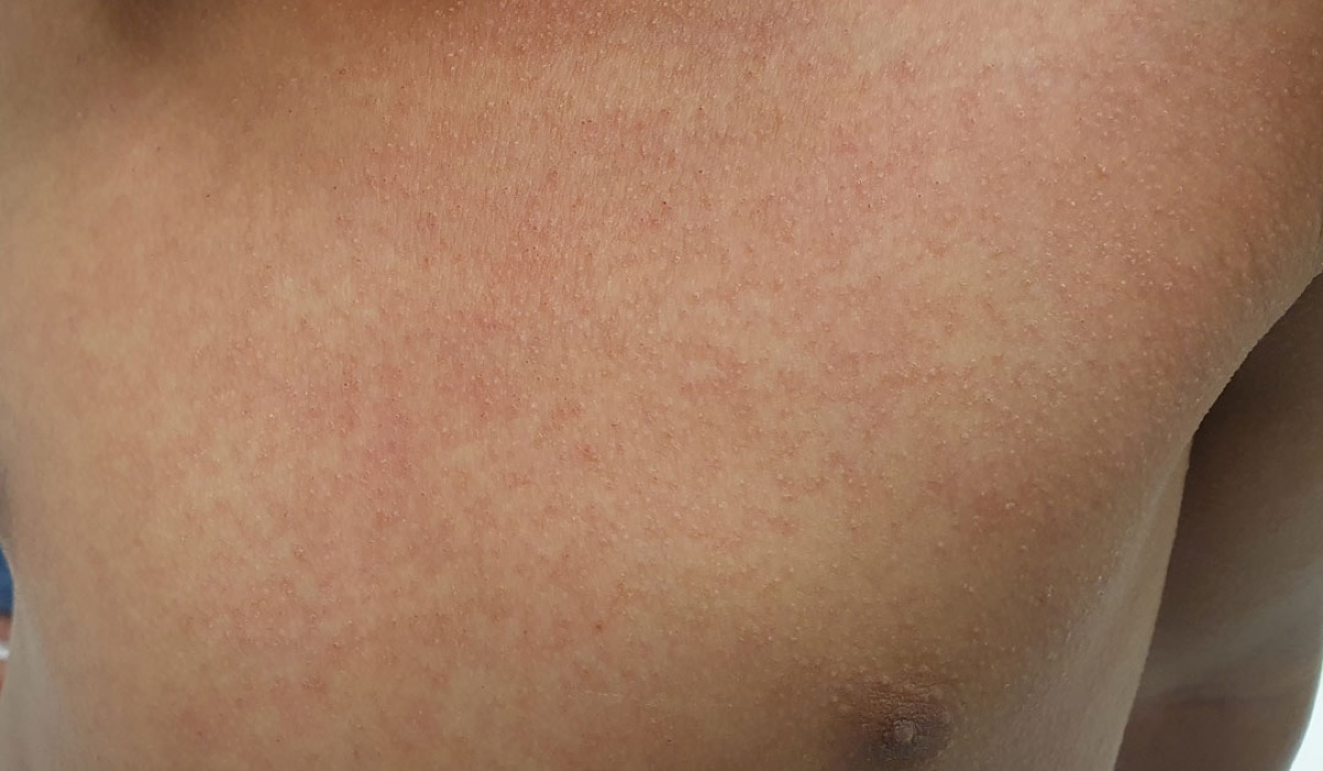 Scarlet Fever | Recent Illness or Concern | Healthier Together